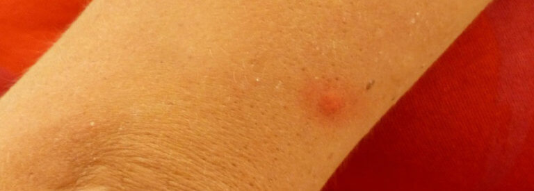 Common House Spider Bites - Identification & How to Treat